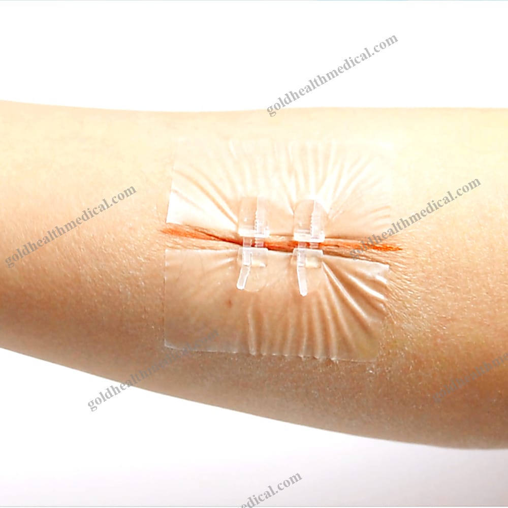 ZipSuture Transparent Painless Wound Closure Patch - GoldHealth Medical ...